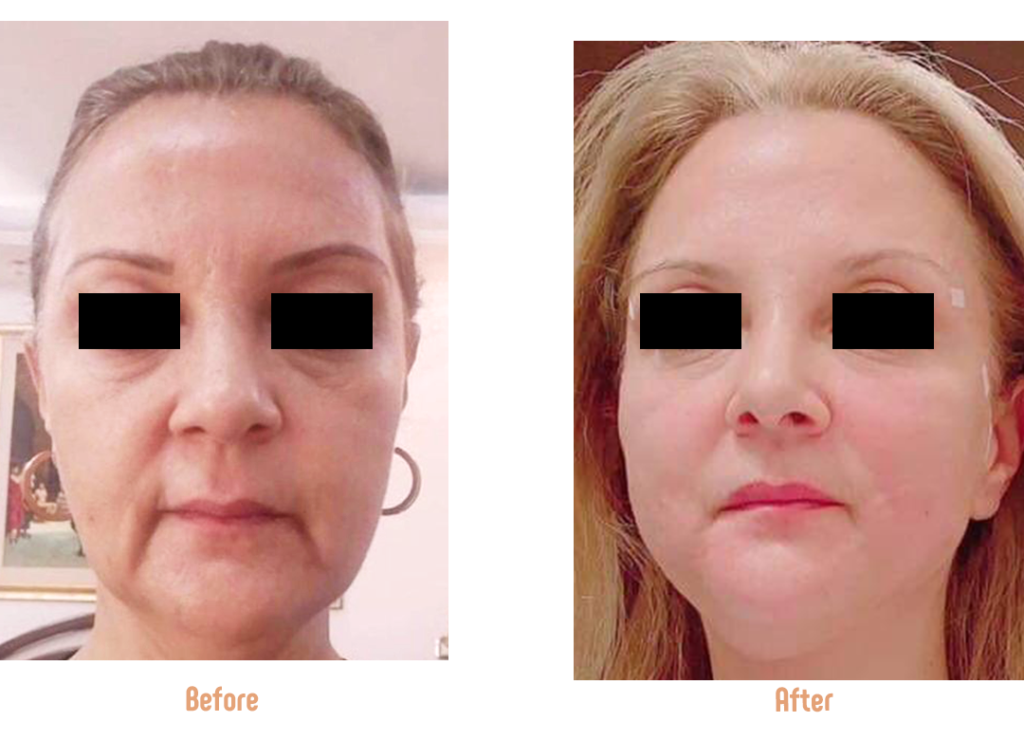 Thread lifting – Dr Dora baccouche