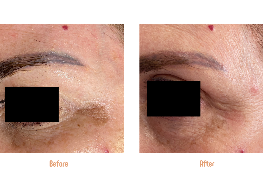 Laser pigmentaire – Dr Dora baccouche