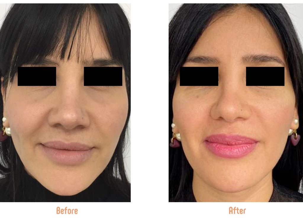 Ultherapy – Dr Dora baccouche